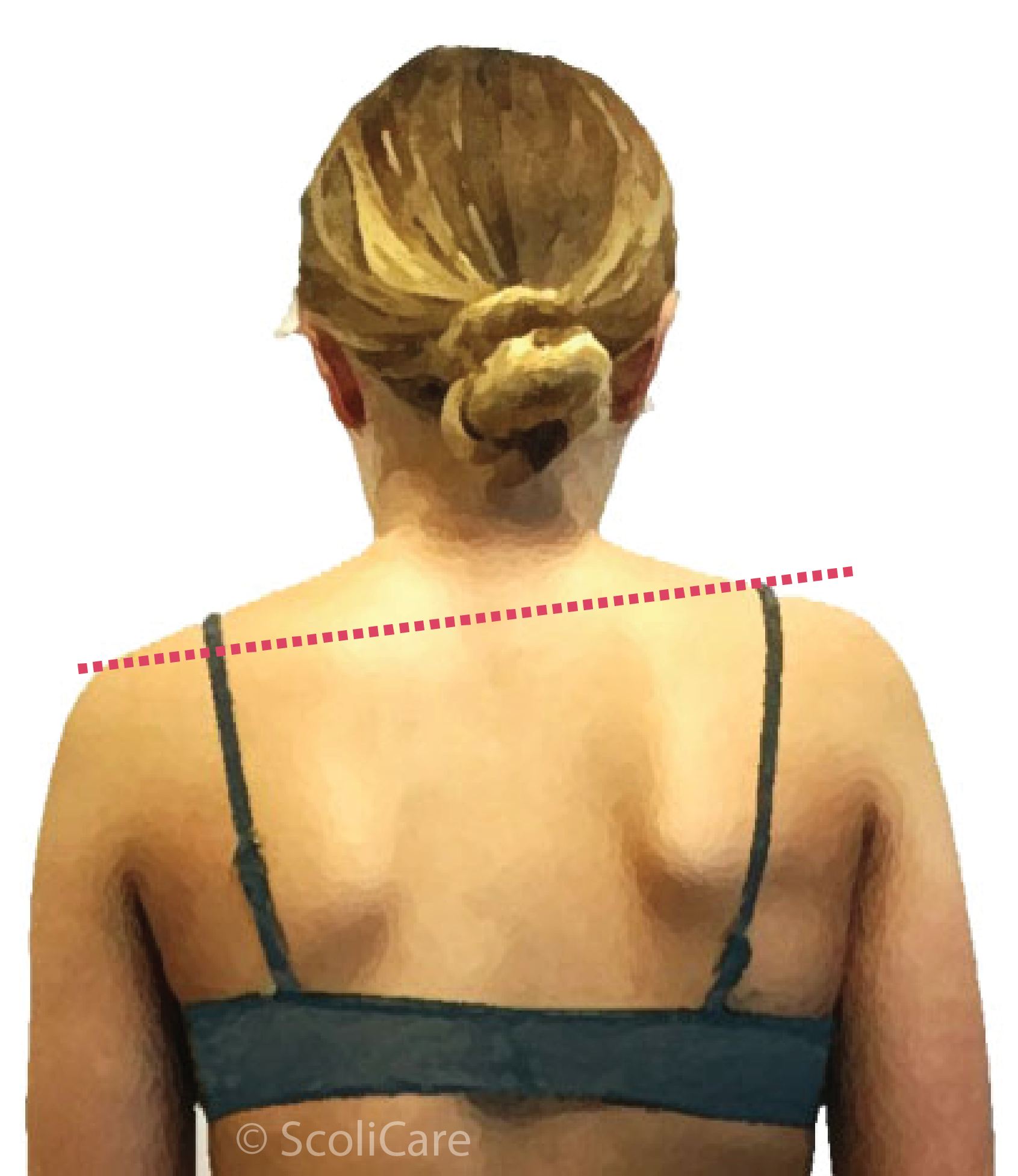 How Can I Check For Scoliosis Scoliosis Clinic UK Treating 