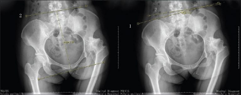 leg length discrepancy Archives - Scoliosis Clinic UK - Treating ...